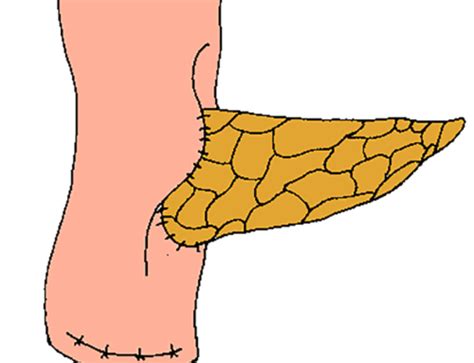One Purse String Suture And Two U Shaped Mattress Sutures The Pancreatic Anastomosis