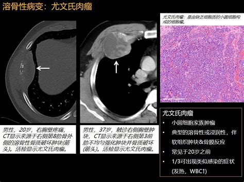 肋骨肿瘤肿瘤样病变及获得性非创伤性病变的影像诊断基本思路 肋骨 骨性 异常 病变 骨瘤 健康界