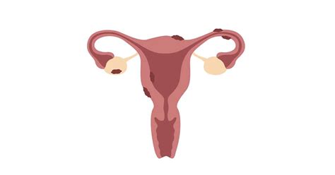 Ranzcog Welcomes New Treatment And Management Of Endometriosis