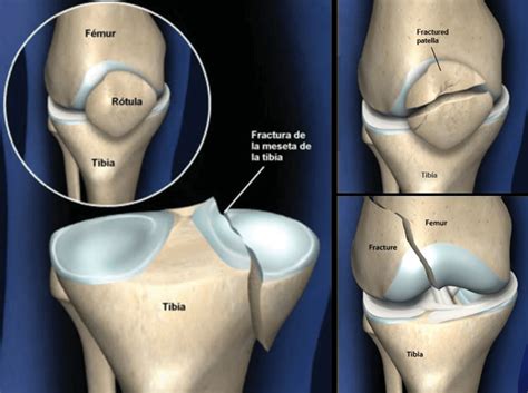 Síntomas De Fractura De Tibia Fractura De Los Primeros Pasos