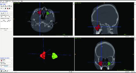 Segmentation Procedure Of Ma­ Xillary Sinus Using Itk­snap Download Scientific Diagram