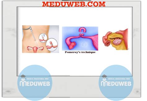 Surgical Contraceptive Methods Meduweb