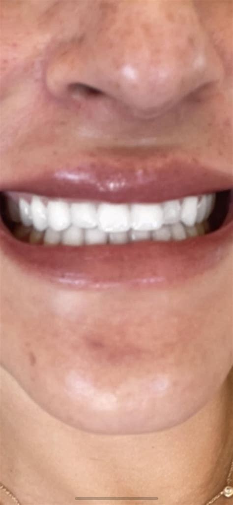 34 Trays Mild Case I Thought Rinvisalign