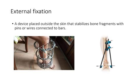 Principle Of Internal And External Fixation Slideshare Pptx First