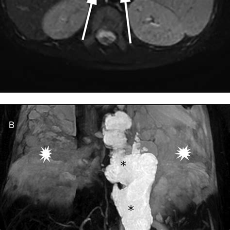 A An Axial T2 Weighted Image With Fat Suppression Showing Thinning Of