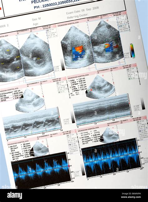 Echocardiogram Report
