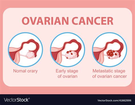 Ovarian Cancer Infographic Royalty Free Vector Image