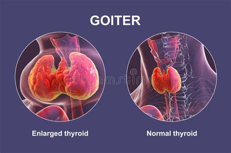 Enlarged Thyroid Gland 3d Illustration Stock Illustration