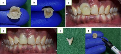 Adjustment And Relining Of Interim Restoration A Temporary Crown