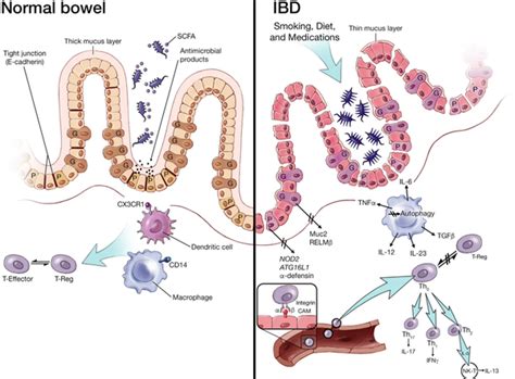 Ibd