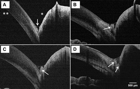 Conjunctivochalasis A Systematic Review Survey Of Ophthalmology
