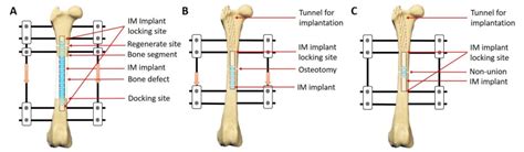 Bioactive Implant For Reconstruction Of Bone Defect Deformity And