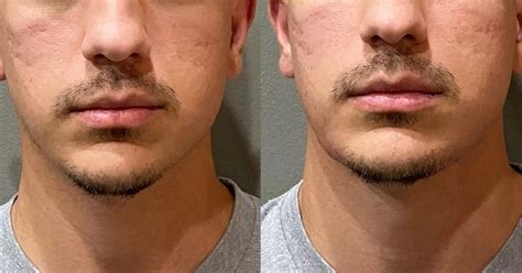 Houston Male Facial Sculpting For Better Jawline Lush Rx Lush Rx