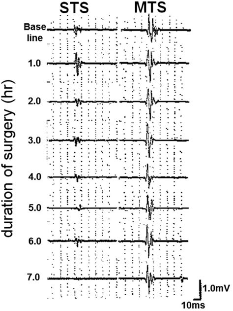 The Trial To Trial Variability Of Transcranial Motor Evoked Potentials Download Scientific