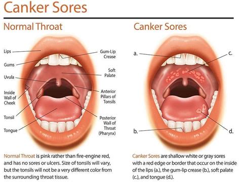 Canker Sores And Their Triggers And Treatments Artofit