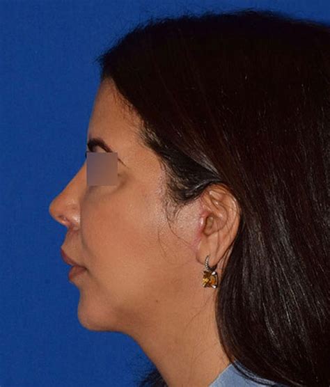Patient 359219 Lip Lift Before And After Photos Robb Facial Plastic