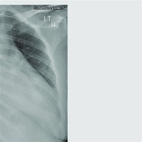 Chest X Ray Anterior Posterior View Revealing Bilateral Bibasilar Download Scientific Diagram