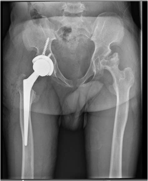 Postoperative Right Tha Ap Pelvis Radiograph Download Scientific Diagram