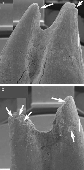 5 External Root Resorption And Orthodontic Treatment—assessment Of The