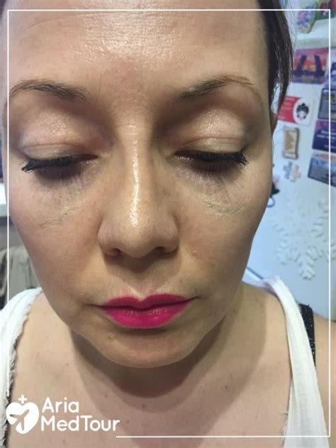 Rhinoplasty Risks And Complications All You Need To Know AriaMedTour
