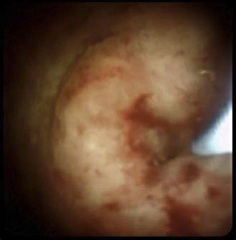 Percutaneous Cholangioscopy Showing A Near Circumferential Mass In The