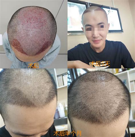 植发10天后轻轻一拔就掉了是失败了吗 知乎
