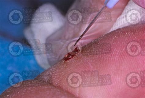 Tunga Penetrans Chigoe Flea Tungiasis Fleas Insecta Insects
