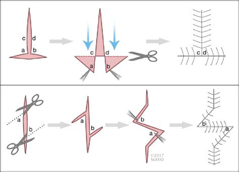 Upper Burows Triangles Advancement Flap Lower The 45 Degree Z