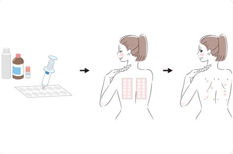 Allergy Patch Testing