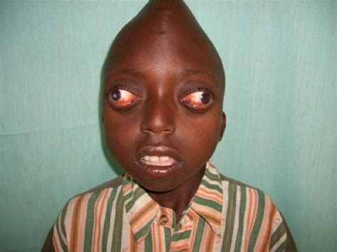 Om Crouzon Syndrome
