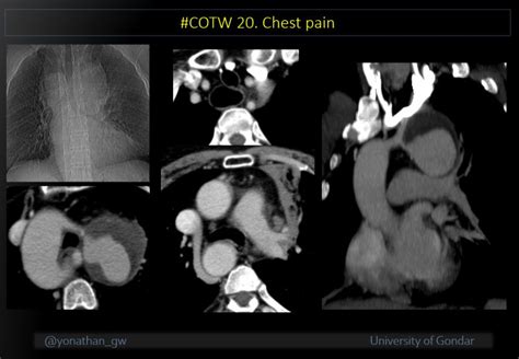 Cotw Radiology Chest Ct Vascular Uog Gondar Ethiopia Yonathan