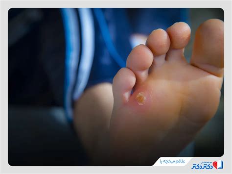 علت میخچه چیست؟ راه های درمان میخچه پا و دست مجله دکتردکتر