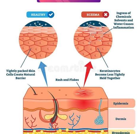 Eczema And Urticaria Allergymums