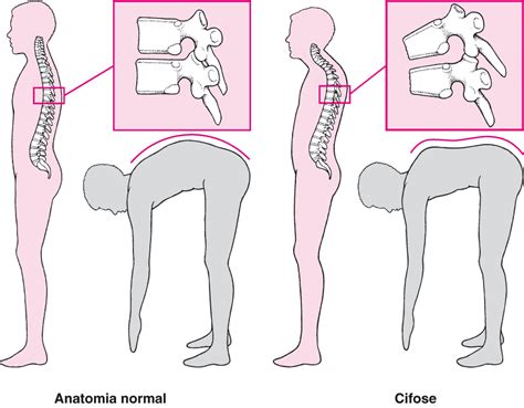 Cifose Doença De Scheuermann Osteocondrose Juvenil Blog Da Saúde