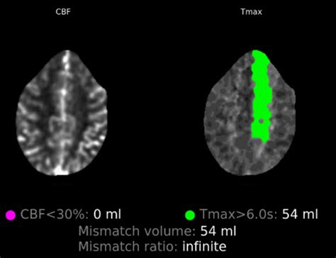 Aca A2 Segment Balloon Mounted Stenting