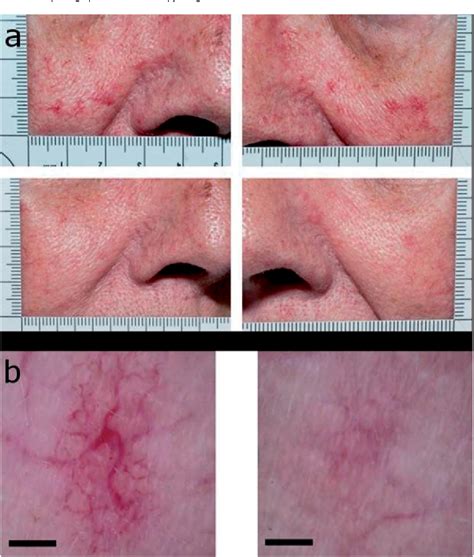 Telangiectasia Scleroderma