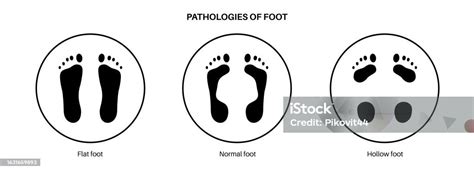 Foot Pathologies Poster Stock Illustration Download Image Now
