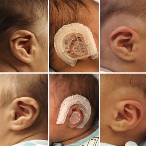 Earwell Newborn Ear Molding Summit Nj