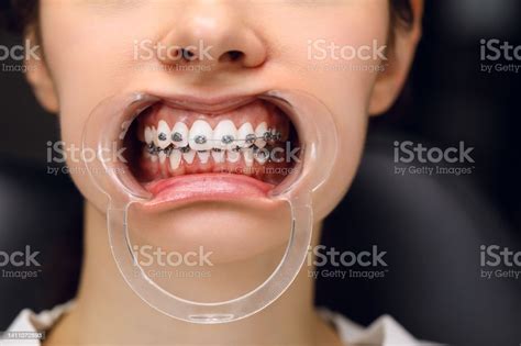 금속 중괄호를 가진 한 젊은 여성이 치과 의사에 의해 검사되고 있습니다 치과 진료소에서 치아의 물린 교정 건강한 치아의 개념 치과교정전문의에 대한 스톡 사진 및 기타 이미지