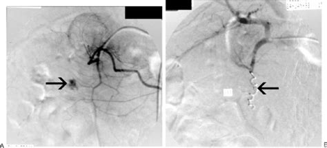 A Selective Gastroduodenal Arteriography Revealed A Pseudoaneurysm Download Scientific