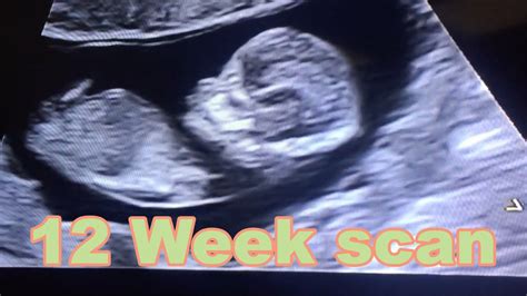 Its A Boy Ultrasound 12 Weeks Nub Theory 12 Week Ultrasound I Am