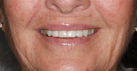 Bioclear Teeth Molson Park