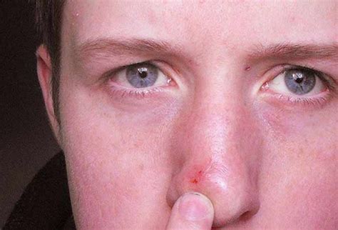 Ingrown Hair In Nose Pictures Pimple Symptoms Pluck Infection On Inside Outside Removal