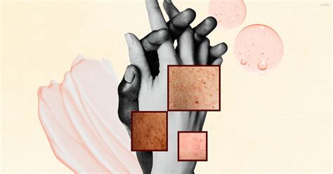Couples Share How Skin Conditions Impact Their Relationship Ps Beauty