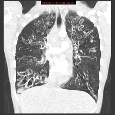 23 Hrct Of Cf Lungs Showing Multiple Severe Bronchiectasis