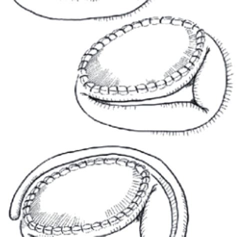 The Anterior Leaflet Of Tv Is Enlarged By Using A Pericardial Patch