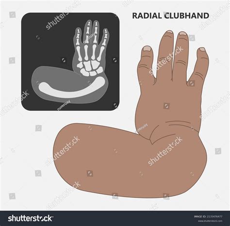 Hand Finger Gene Prader Willi Band Stock Vector Royalty Free