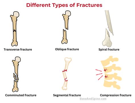 Spiral Fracture
