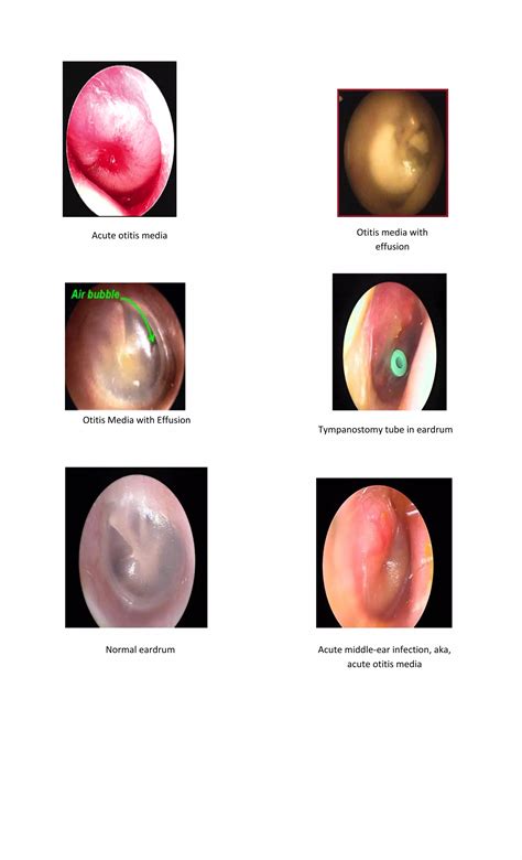 Tympanic Membrane Normal Appearance