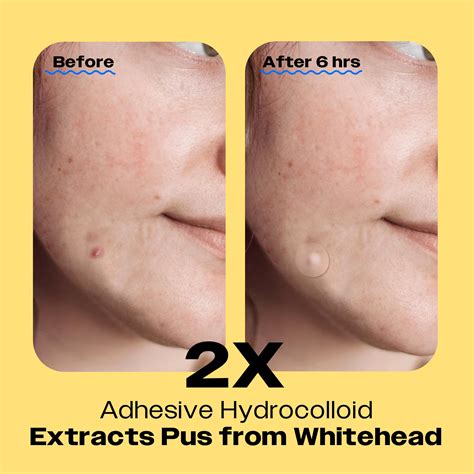 Whitehead Pimple On Pubic Area